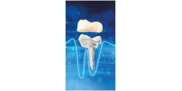 Dentaire365 - Sivp Dentaire: L'inlay-core en fibres de verre