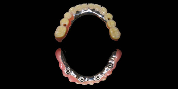 Dentaire365 - Utilisation du flux numérique en implantologie - Guide ...